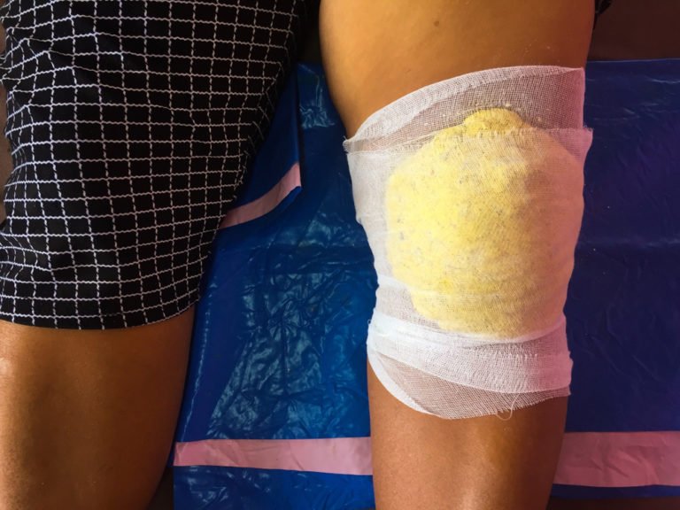 Cataplasma, tutto su questo antico rimedio naturale